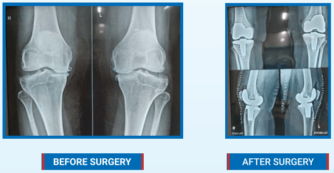 Knee Replacement Surgeon in Pune - Dr. Murtaza Adeeb